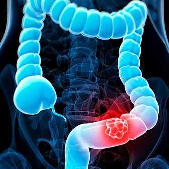 Kolon veya Rektum Kanseri Ameliyatı Sonrası Takip Nasıl Olmalı?